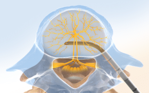 Intracept® - The Pain Center