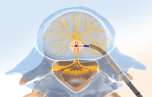 Intracept® - The Pain Center